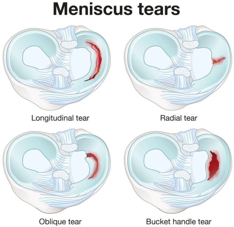Meniscus Tears: Treatment Options and Recovery Guide - OrthoNJ